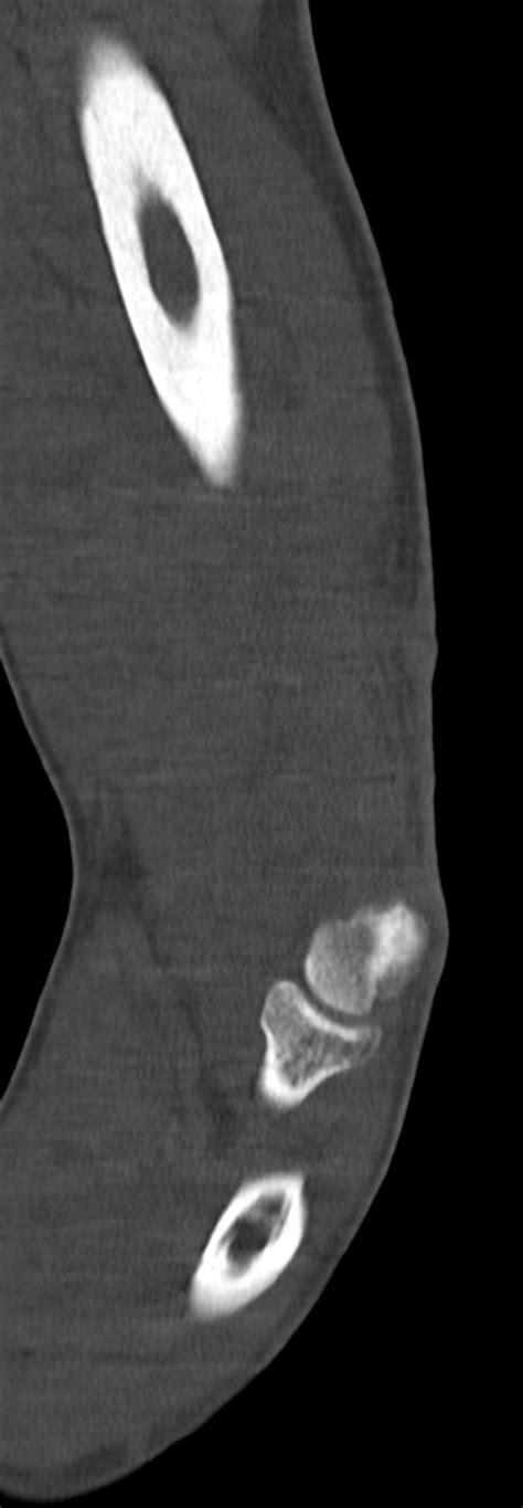 Chronic Osteomyelitis Of The Distal Humerus Radiopaedia 78351 90971 Sagittal Bone Window Nc