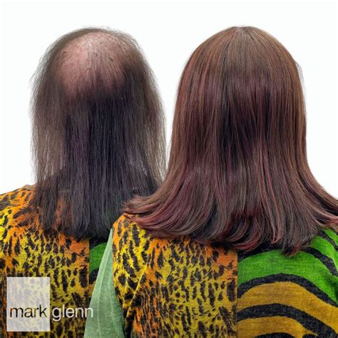 Hl116 Cancer Chemotherapy Permanent Hair Loss Transformation Mark