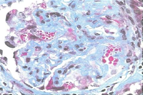 Collapsing Fsgs It Shows Podocyte Hypertrophy Download Scientific