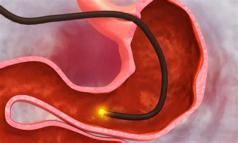 Endoscopy Stomach Biopsy Results At Joseph Florence Blog