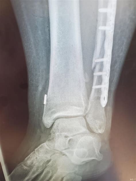Left Ankle Orif The Breaker Of Said Ankle Rorif