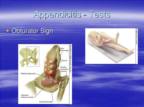 What Is An Appendicitis Test Livlong