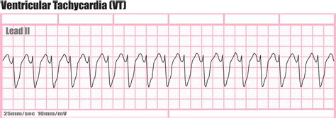 Tachycardia Causes Signs Symptoms Types Diagnosis And Treatment