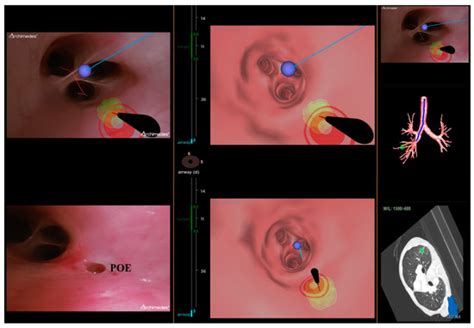 Diagnostic Performance Of Electromagnetic Navigation Versus Virtual Navigation Bronchoscopy