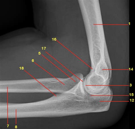 Standard Elbow X Ray Views Elbow X Ray Interpretation Kxvg