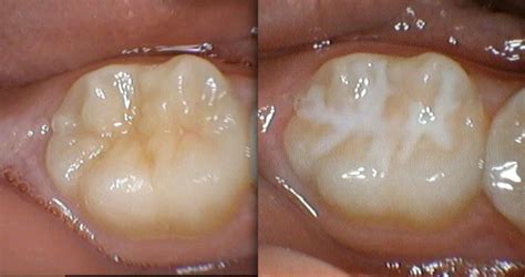Fissure Sealants — Western Dental Hygiene