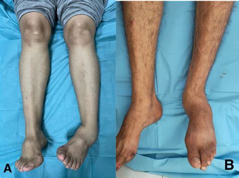 Pure Subtalar Dislocations About 7 Cases And A Review Of The
