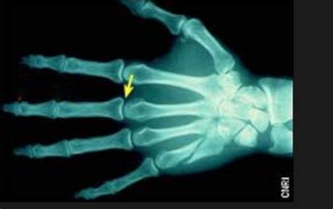 Hand And Wrist Flashcards Quizlet