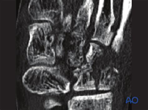 Multifragmentary Cuboid Fracture