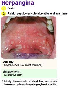 Herpangina In Adults