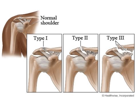 Upper Limb Pathologies Flashcards Quizlet