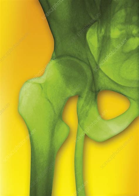 Normal Pelvic Veins Venogram Stock Image F0013016 Science Photo