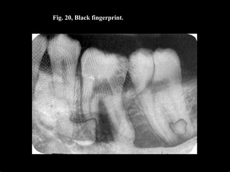 Lecture 7 Dental X Ray Film Processing And Processing Errors Lecture 7