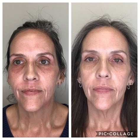 How Does Co2 Laser Work On Skin At Vivian Beck Blog