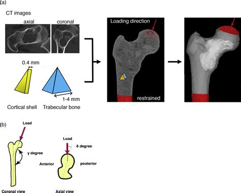 The Risk Assessment Of Pathological Fracture In The Proximal Femur