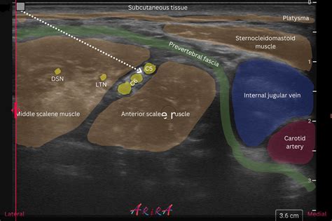 Interscalene Brachial Plexus Block