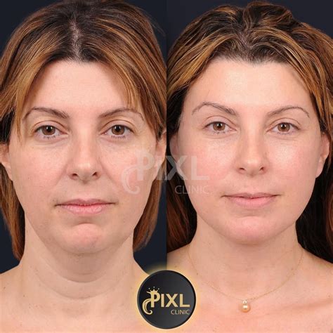 Neck Liposuction Before And After Pixl Clinic