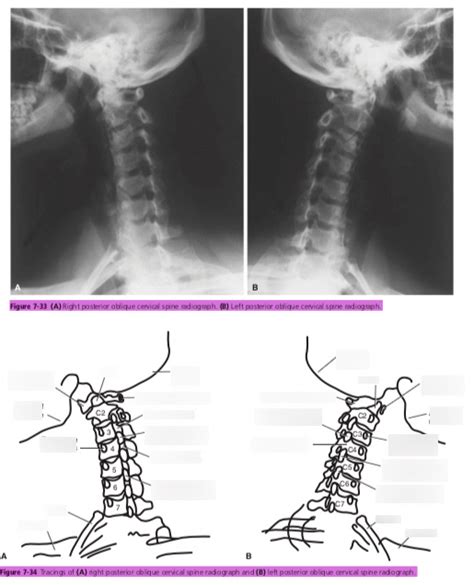 Right And Left Oblique Cervical Projections Diagram Quizlet