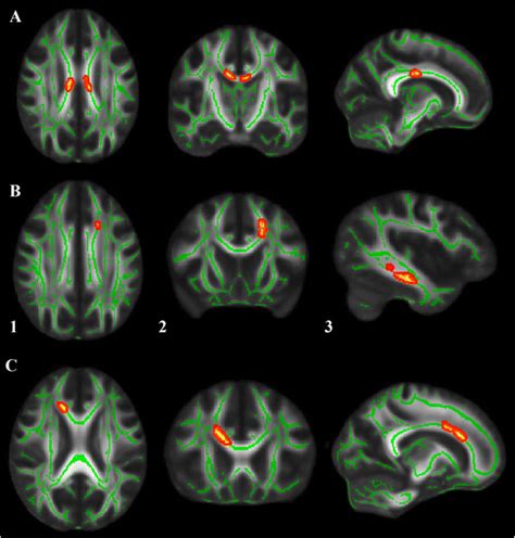 Whole Brain Tract Based Spatial Statistics Results Overlaid On Axial