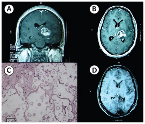 Puerperal Brain Cryptococcoma In An Hiv Negative Woman Successfully