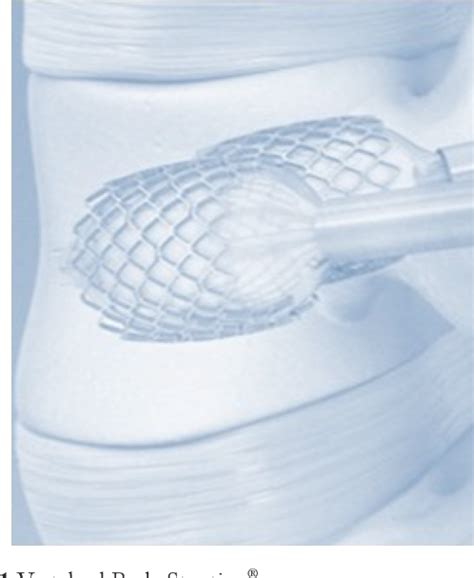 Figure 1 From Third Generation Percutaneous Vertebral Augmentation