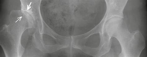 Figure 031 4173 Right Hip Dysplasia A Shallow And Steep Acetabulum Flattened Right Femoral