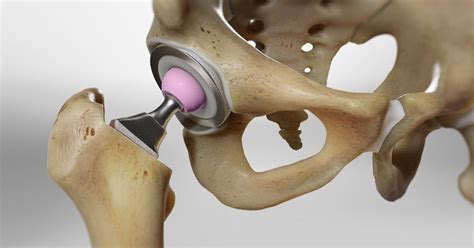 Common Myths On Hip Arthroplasty You Should Never Believe