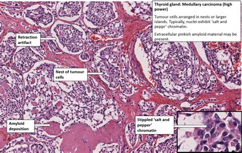 Thyroid Medullary Carcinoma Nus Pathweb Nus Pathweb