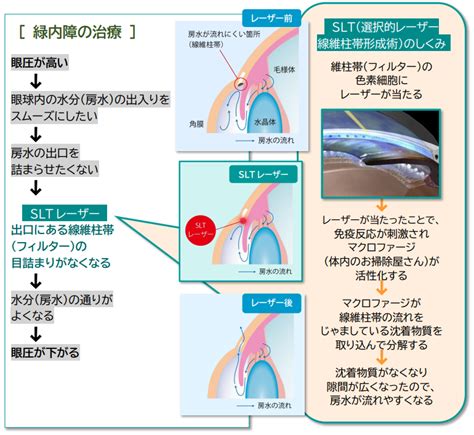 緑内障レーザーSLT選択的レーザー線維柱帯形成術武蔵浦和 さいたま市の眼科あしかわ眼科