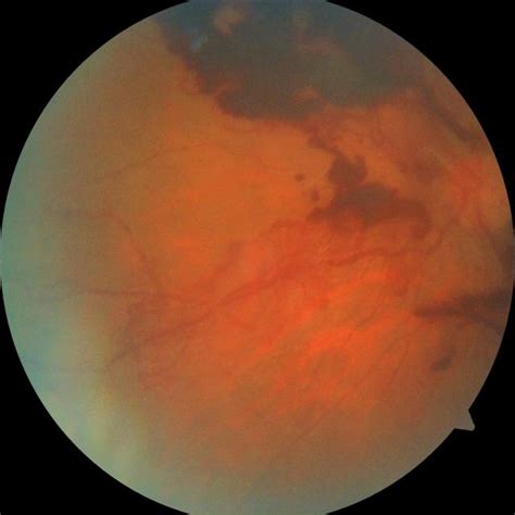 Diabetic Retinopathy Classification Dataset V1 2024 01 19 1003pm By Diabetic Retinopathy