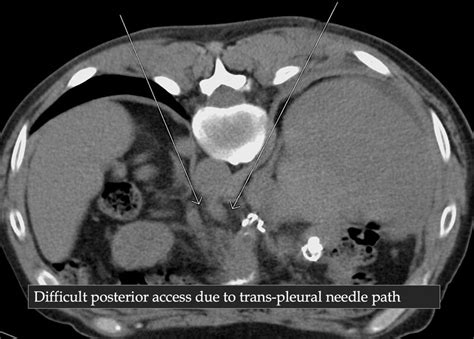 Dr Uday Kumar Marri On Linkedin Irad Sirrfs Isvir Palliativecare