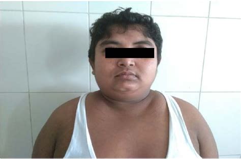 Figure 1 From Cyclic Cushing Syndrome An Enigma In Diagnosis A Case