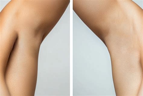 Лечение гипергидроза подмышек инъекции Disport Диспорта и ботокса