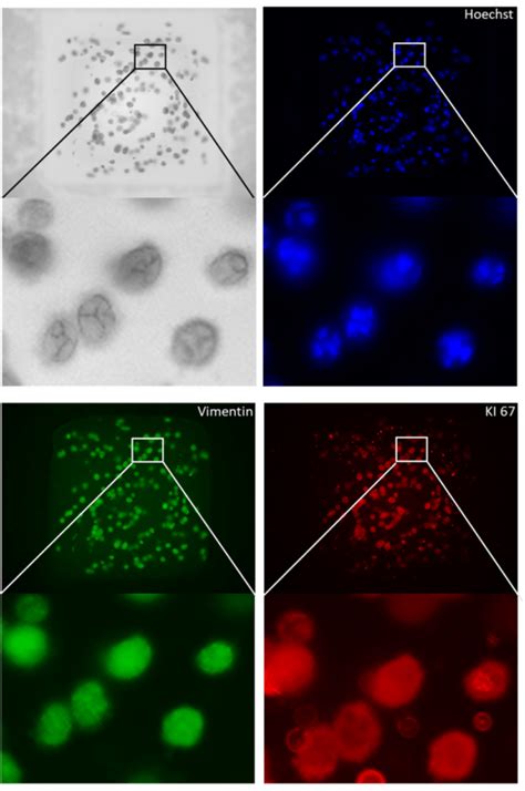 Generation Of Tumor Cell Spheroids In Miniaturized Nanoliter Droplets Using Xeno Free Vitrogel