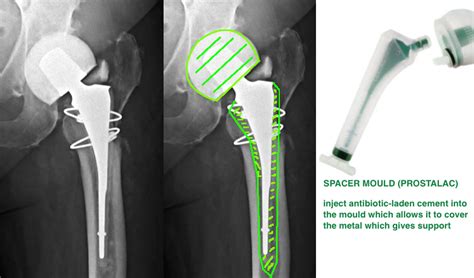 Infection — Hip And Knee Book