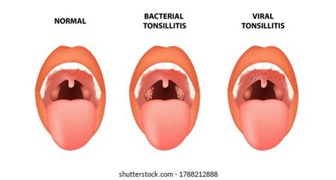 Healthy Tonsil Diagram What Causes Tonsil Stones Oraticx
