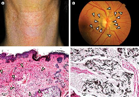 Pseudoxanthoma Elasticum The Lancet