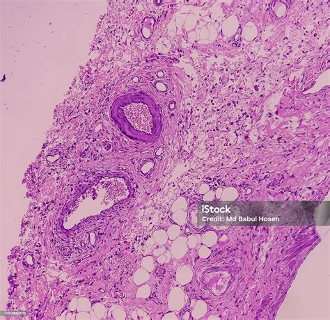 연조직 사구체 종양 또는 부신경절종 현미경으로 연조직 Glomus 종양의 특징 양성이지만 국소 침습성 종양을 보여줍니다 건강 진단에 대한 스톡 사진 및 기타 이미지 Istock