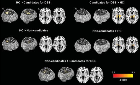 Seed Based Functional Connectivity Analysis Resting State Functional