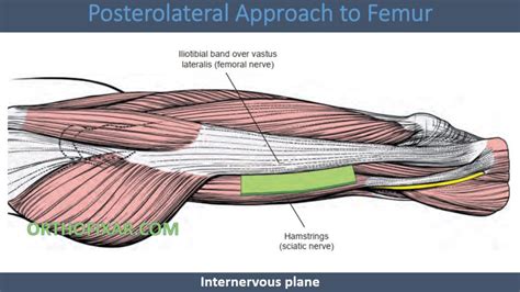 Posterolateral Approach To Femur