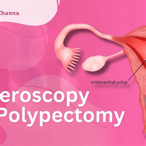 Stream Understanding The Procedure Of Hysteroscopic Polypectomy By Stream Understanding The Procedure Of Hysteroscopic Polypectomy By