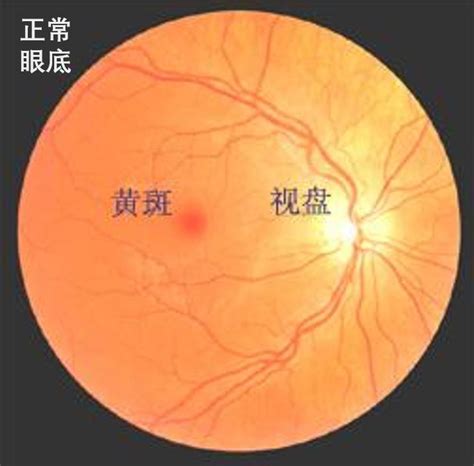 正常眼底图手绘图 眼底图手绘图 手绘正常眼底示意图 第5页 大山谷图库