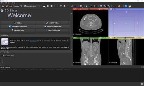 Software To Visualizeannotate Dicomnifti Files Pycad Your Medical