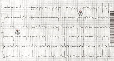 Ecg Basics And Fundamentals Causes Of Prolonged St Segment Ecg Weekly