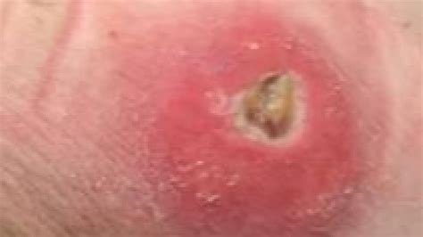 Victoria Dire Health Warning As Flesh Eating Buruli Ulcer Disease