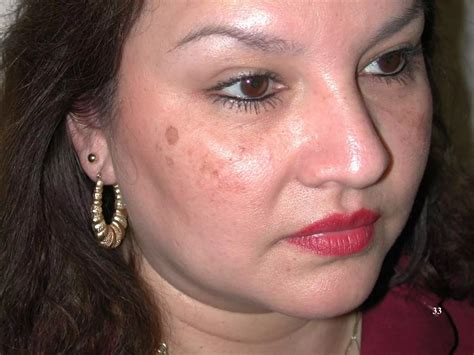 18photodermatitis Ppt