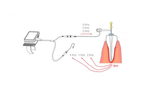 Apex Locator Medical Dental Solutions
