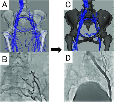 Postthrombotic Iliac Vein Occlusion And The Venous Stenting A Download Scientific Diagram