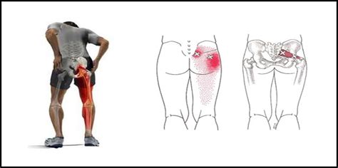 Síndrome Do Piriforme Portal De Esporte E Saúde