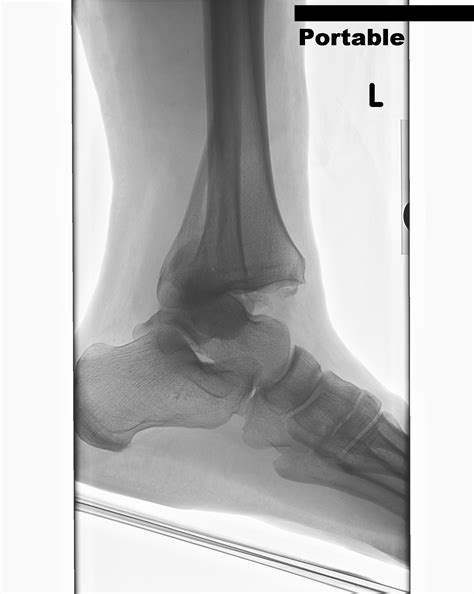 Dislocated Ankle X Ray
